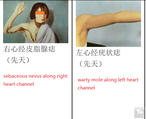 Dermatosis Along Channels